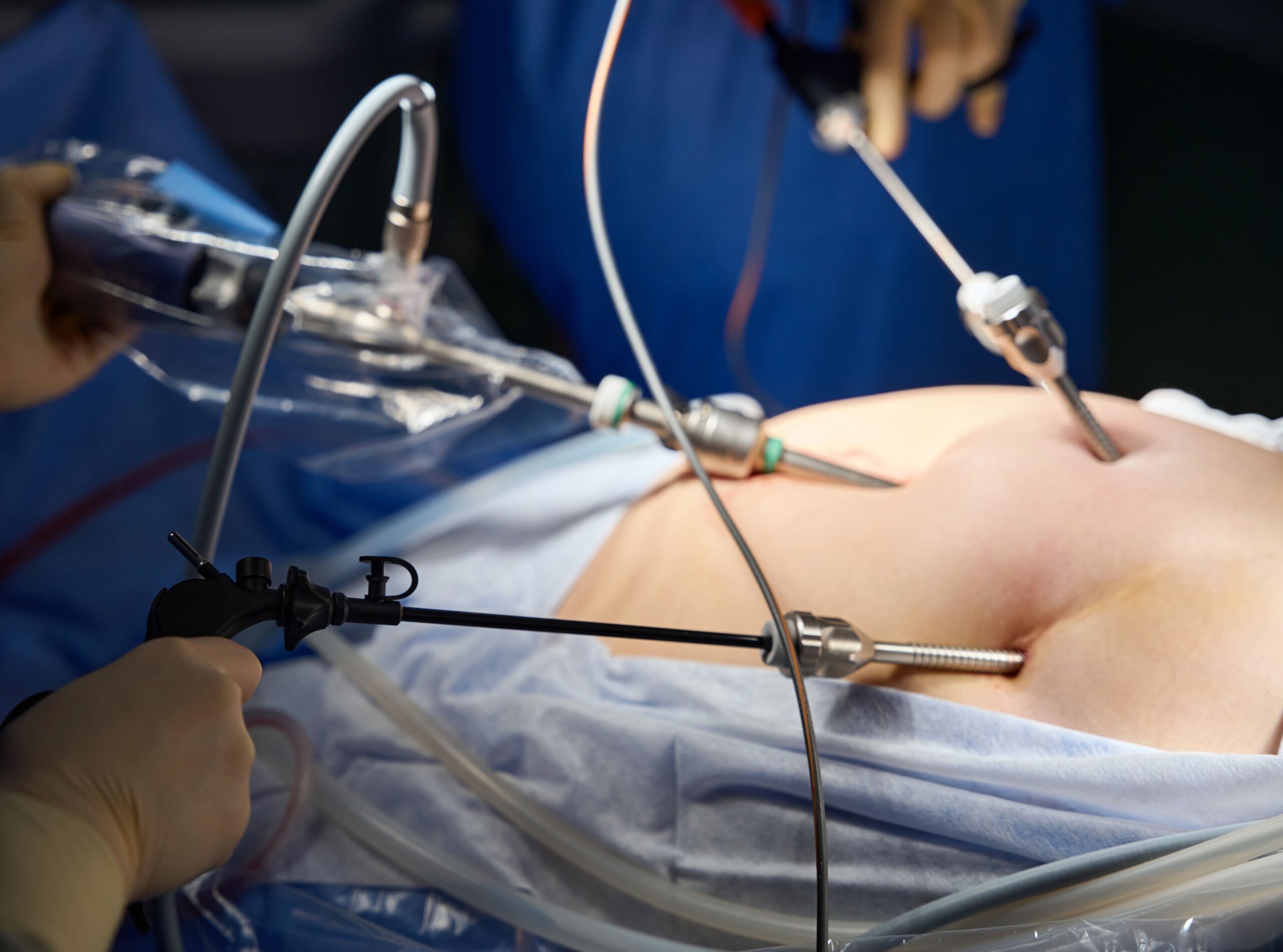 Laparoscopic Nephrectomy Singapore | Kidney Surgery